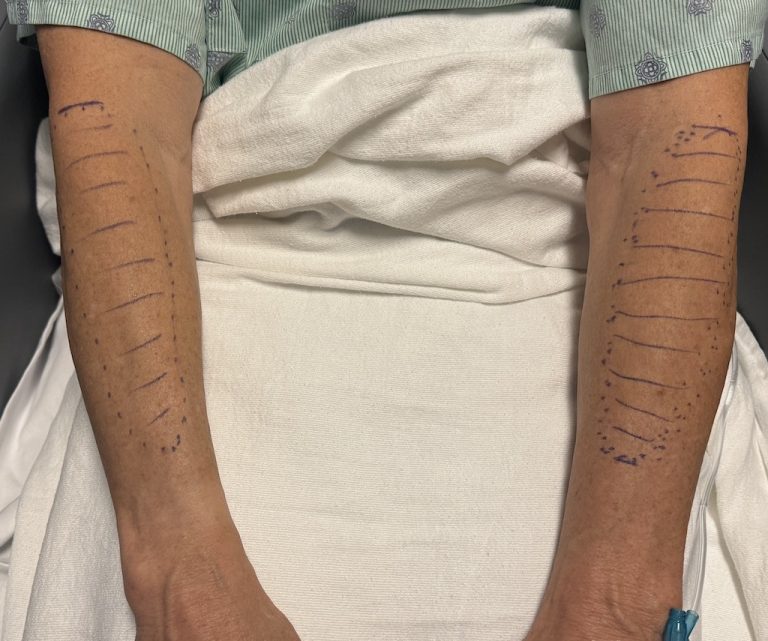 forearm implant markings Dr Barry Eppley - Explore Plastic Surgery