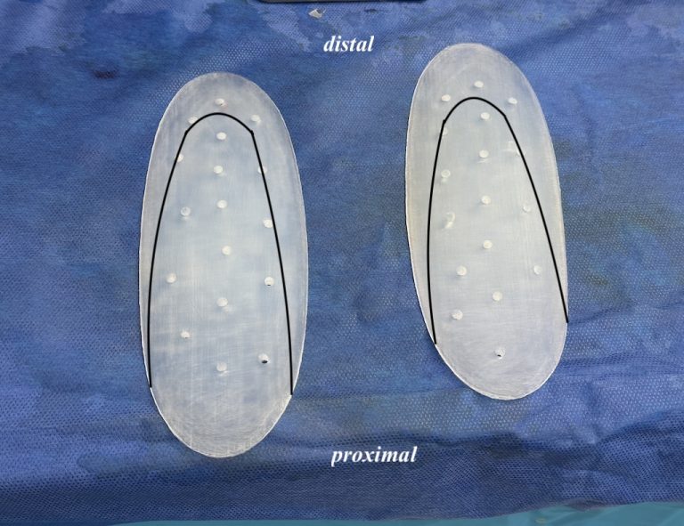 forearm implants with perfusion holes intraop Dr Barry Eppley - Explore ...