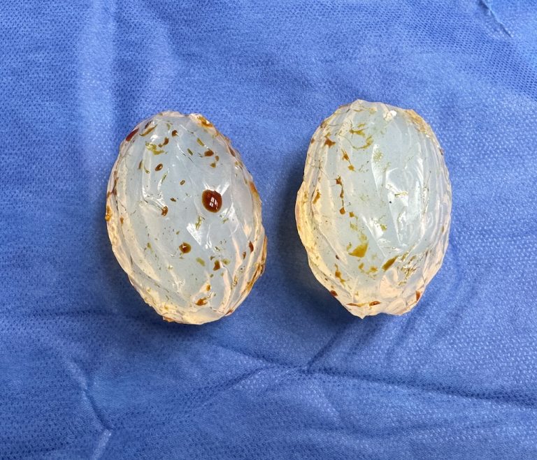 Plastic Surgery Case Study - Custom Testicle Implants in the Penile ...