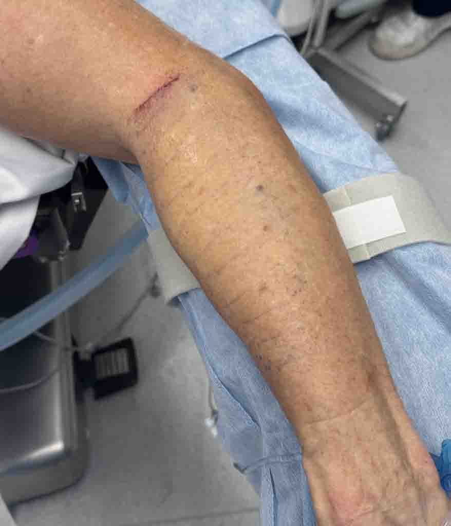 Plastic Surgery Case Study - The Anatomy and Design of Custom Forearm ...