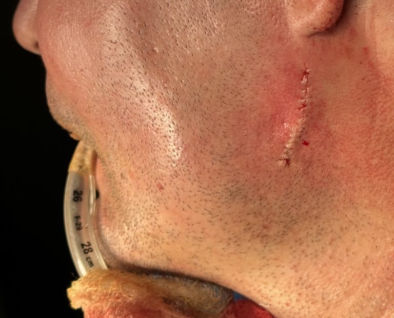 Plastic Surgery Case Study - Transcutaneous Placement of Custom Jawline ...