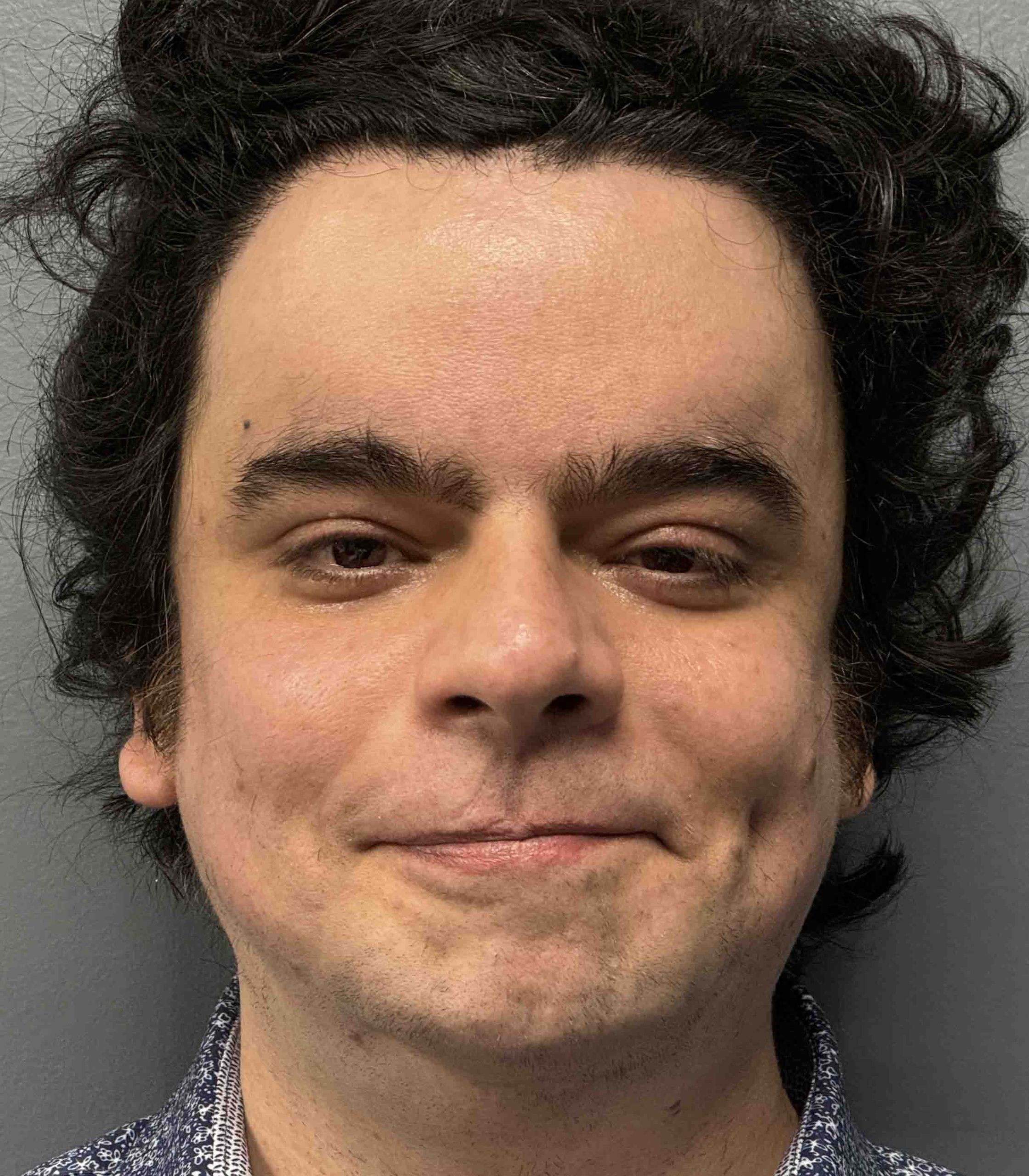 male head widening implant frint 2 Dr Barry Eppley - Explore Plastic ...