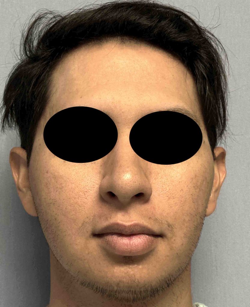 Plastic Surgery Case Study - Type 4 Temporal Augmentation Wrap Around ...