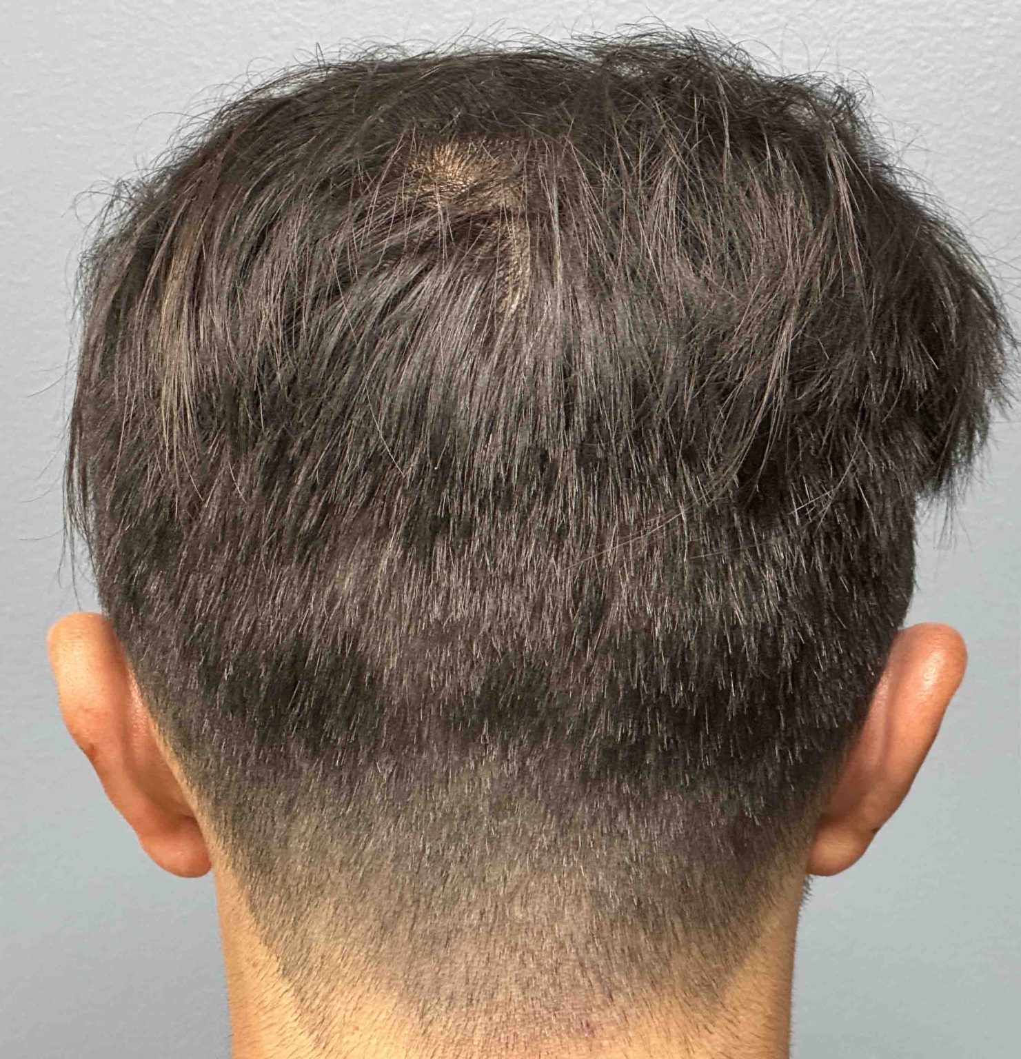 Plastic Surgery Case Study - Type 4 Temporal Augmentation Wrap Around ...