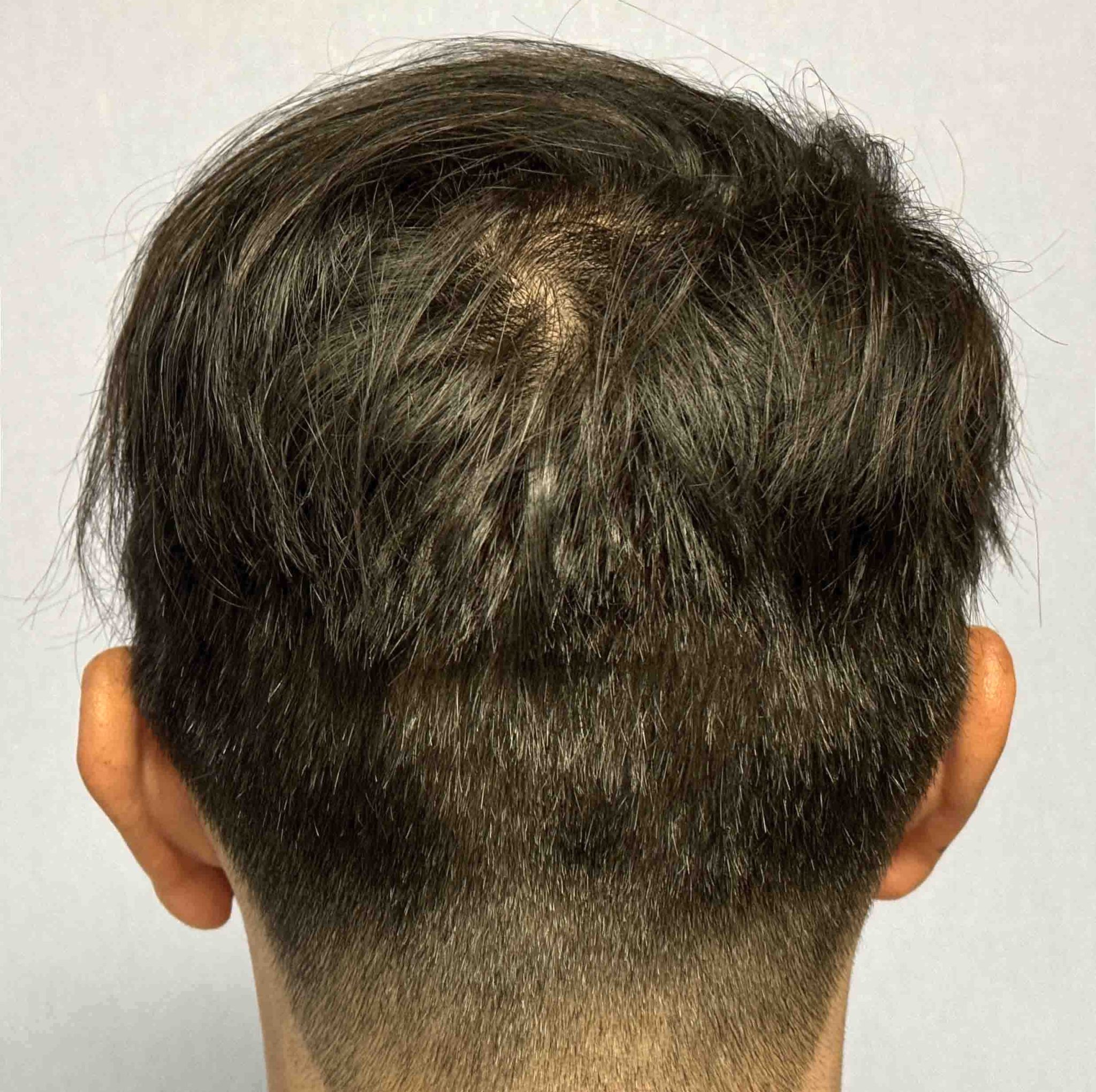 Plastic Surgery Case Study - Type 4 Temporal Augmentation Wrap Around ...