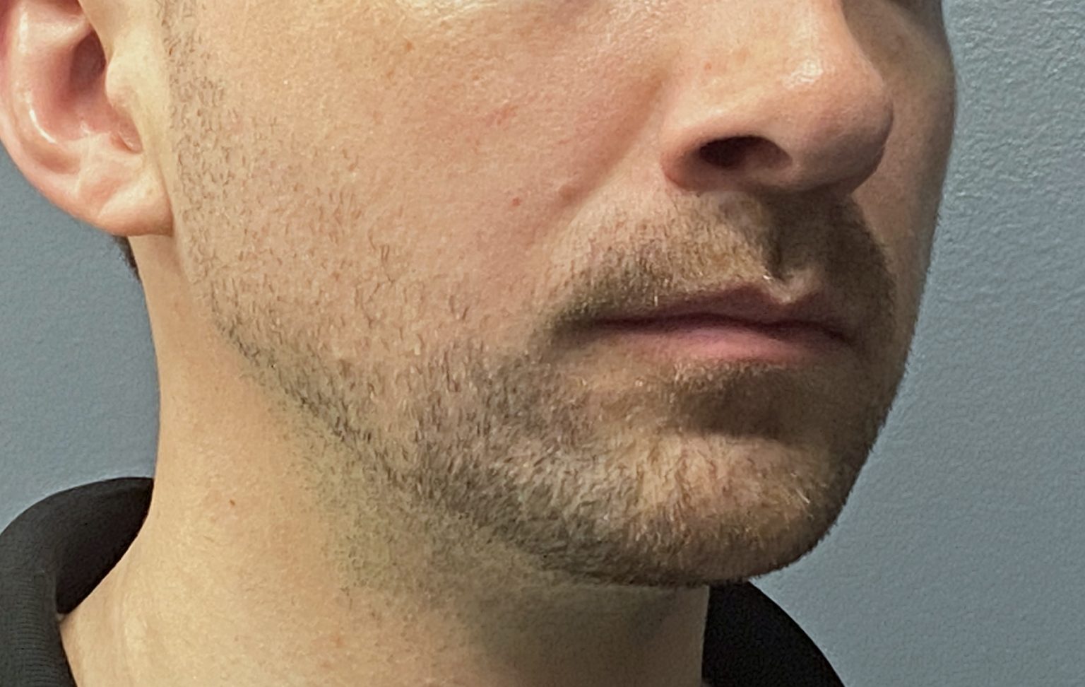 Plastic Surgery Case Study - Graduating from a Chin Implant to a Custom ...
