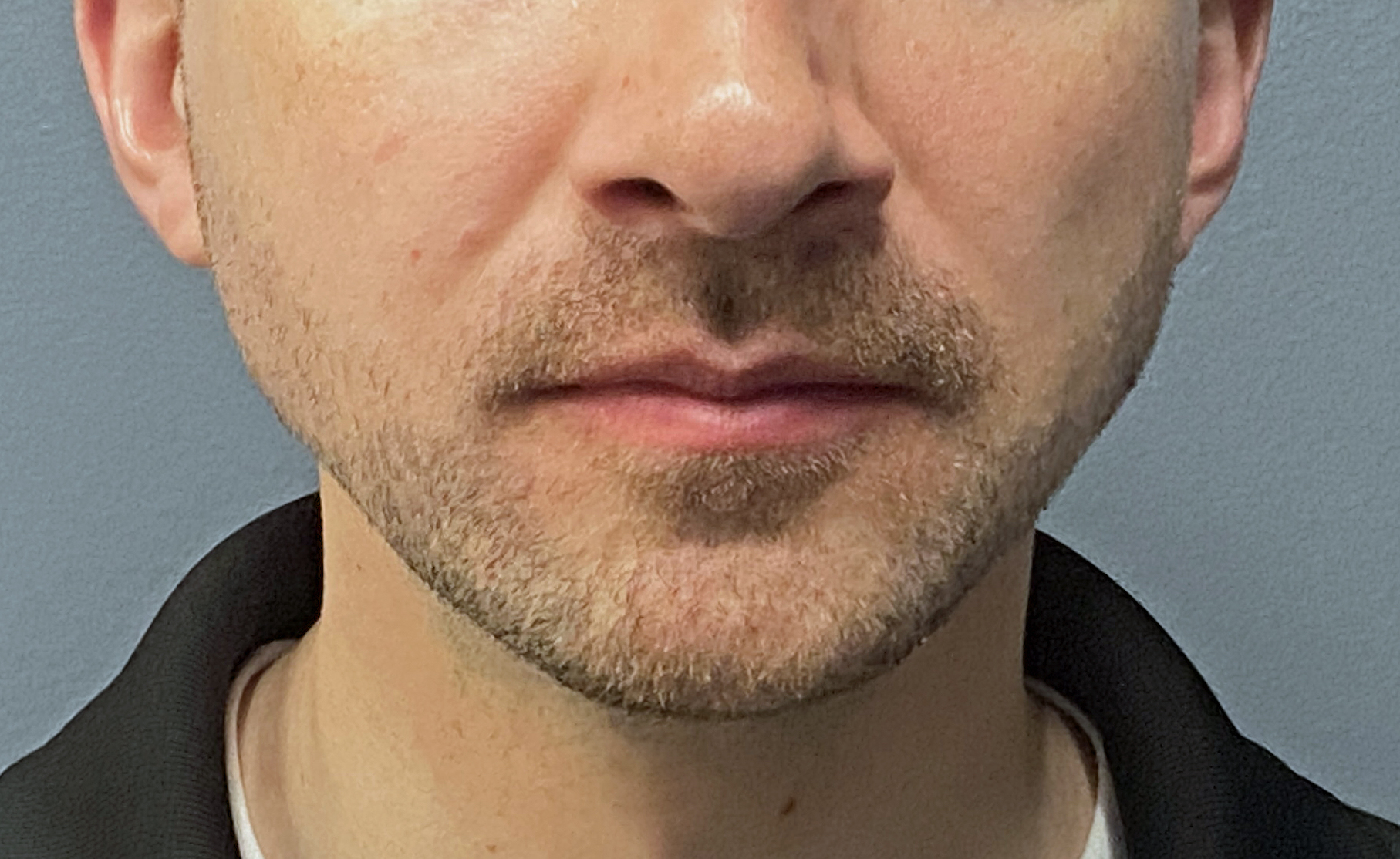 male jawline front 1 Dr Barry Eppley - Explore Plastic Surgery
