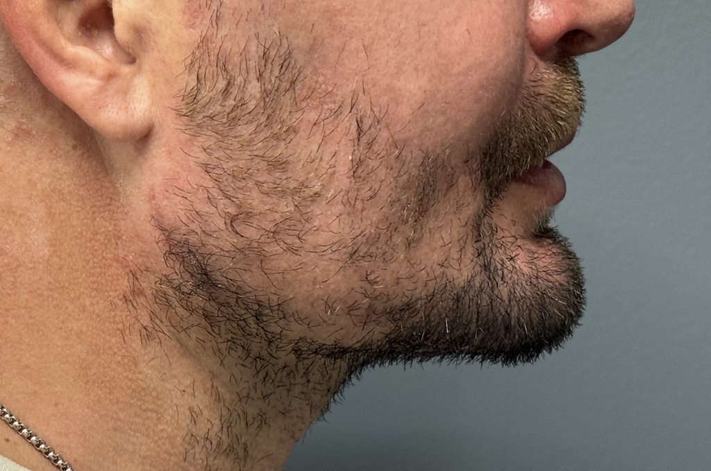 male transcutaneous custom jawline implant side 2 Dr Barry Eppley ...