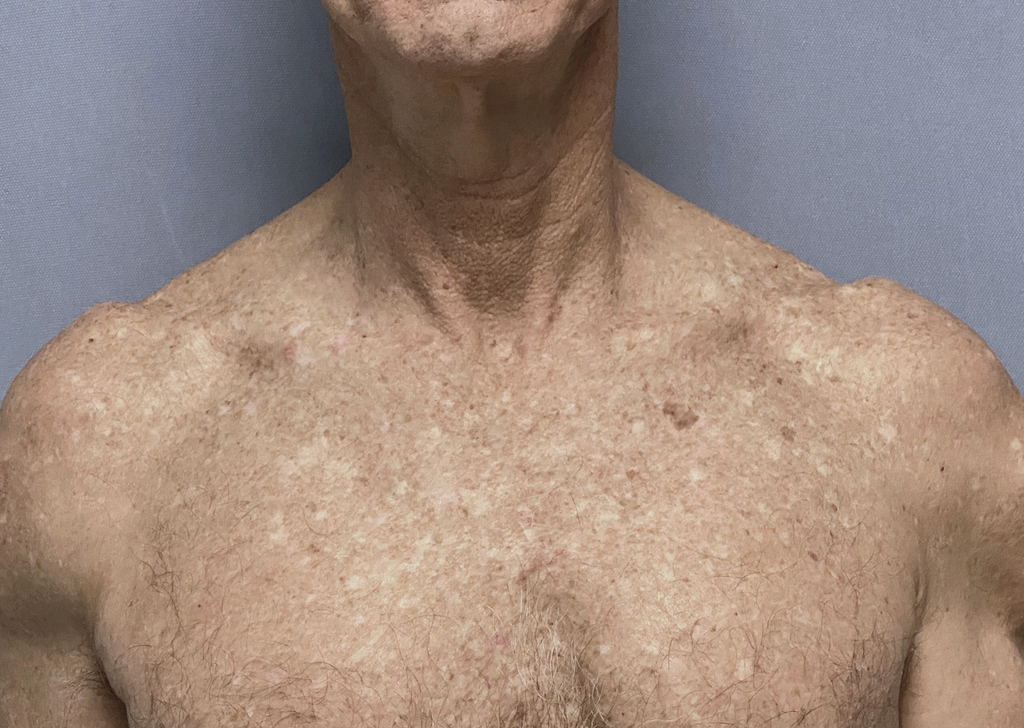 male trap implants front 1 Dr Barry Eppley - Explore Plastic Surgery