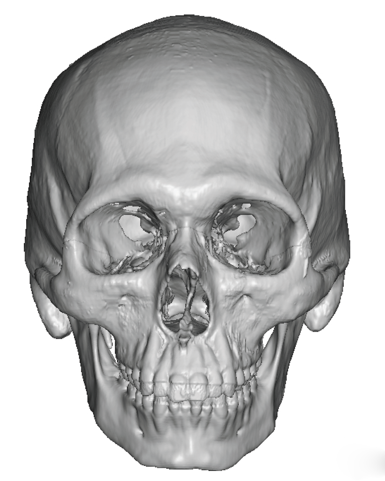 narrow forehead shape 3D CT scan Dr Barry Eppley - Explore Plastic Surgery