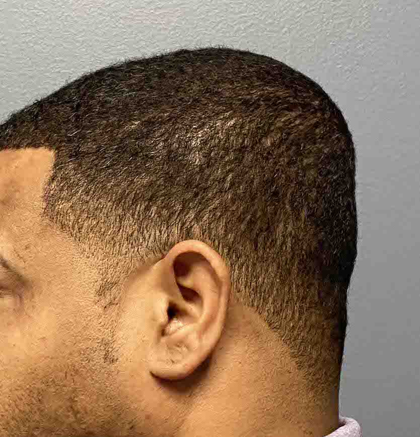 parietal skull reduction side 1 Dr Barry Eppley - Explore Plastic Surgery