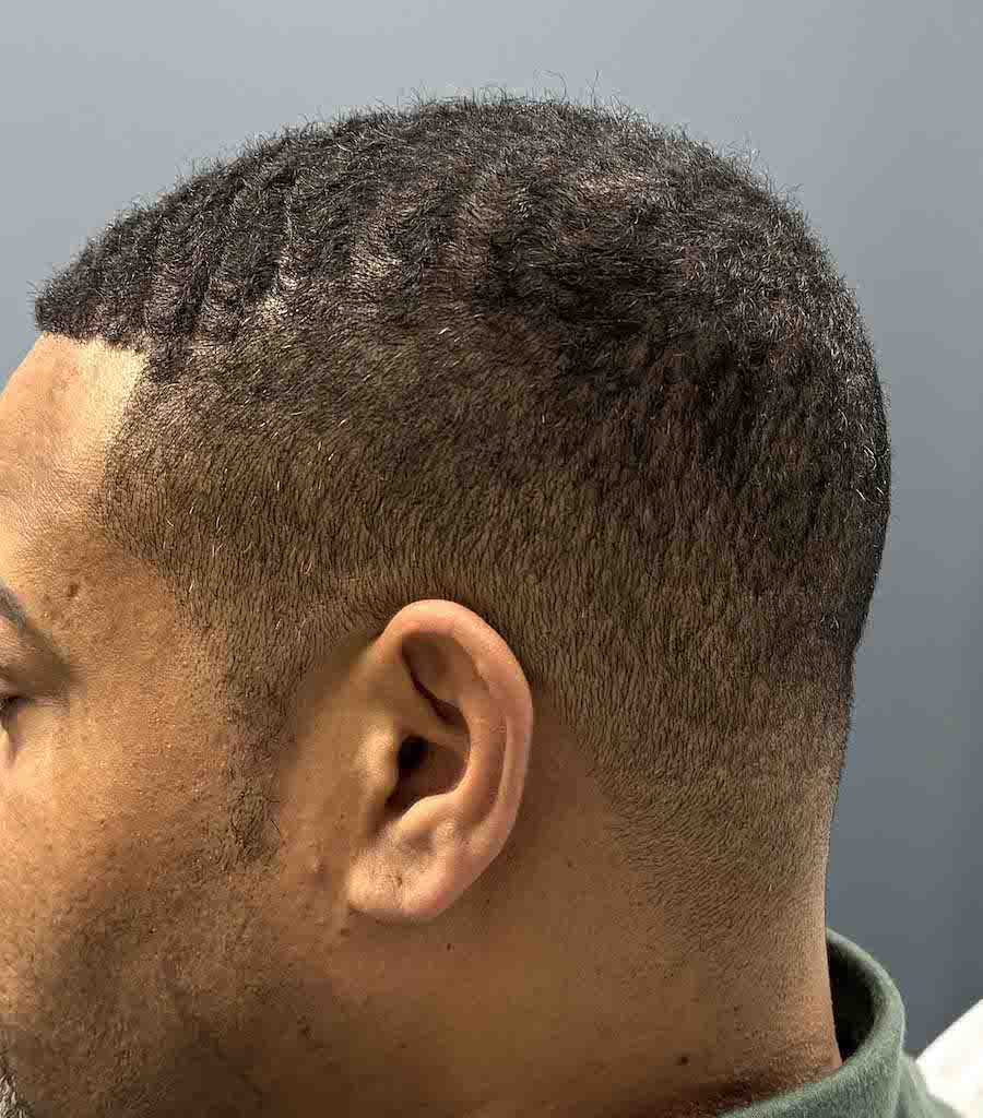 parietall skull reduction side 2 Dr Barry Eppley - Explore Plastic Surgery