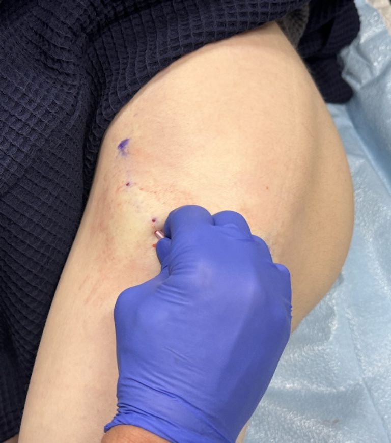 percutaneous hip implant needle release technique 2 - Explore Plastic ...