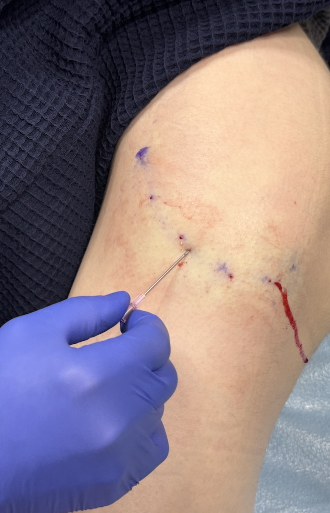 Technical Strategies - Percutaneous Release of Hip Implant Inferior ...