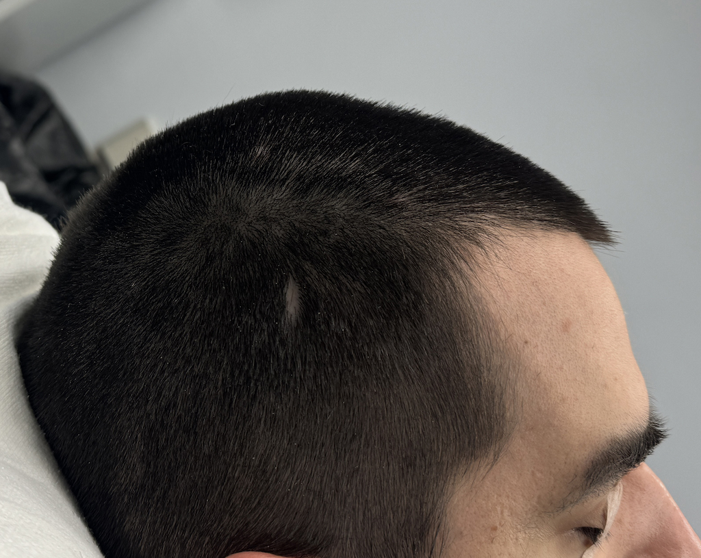 sag crest red side 1 Dr Barry Eppleyjpg - Explore Plastic Surgery