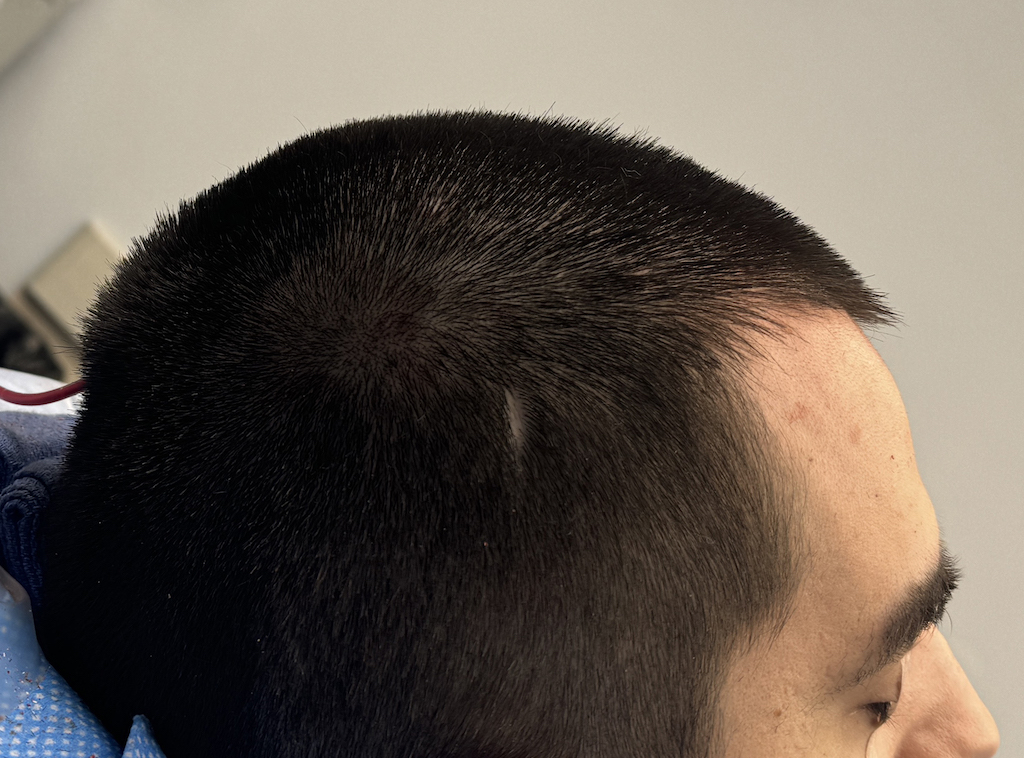 sag crest red side 2 Dr Barry Eppley - Explore Plastic Surgery