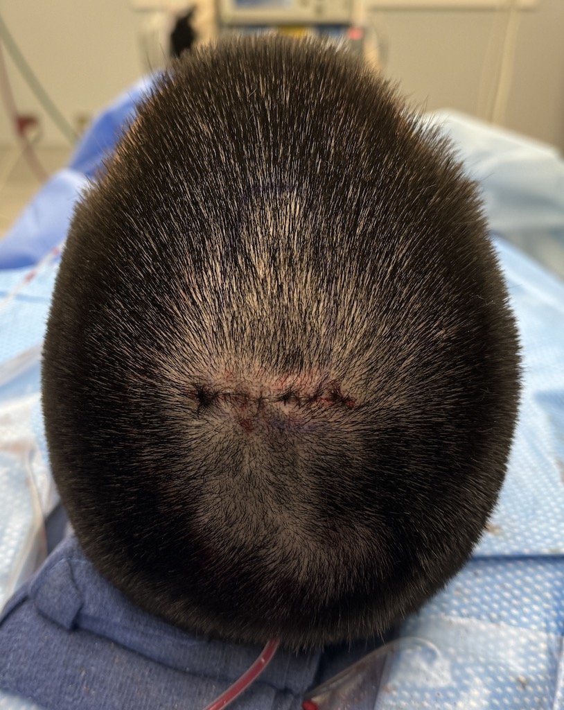 Plastic Surgery Case Study - Sagittal Crest Skull Reduction and Diploic ...