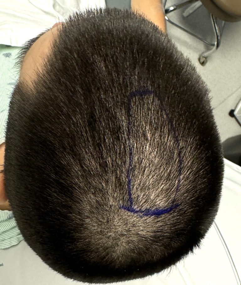 Plastic Surgery Case Study - Sagittal Crest Skull Reduction and Diploic ...