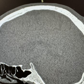 skull reshaping Archives - Explore Plastic Surgery