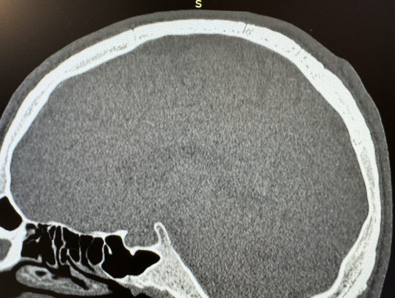 sagittal ridge CT scan DR Barry EppleyJPG - Explore Plastic Surgery