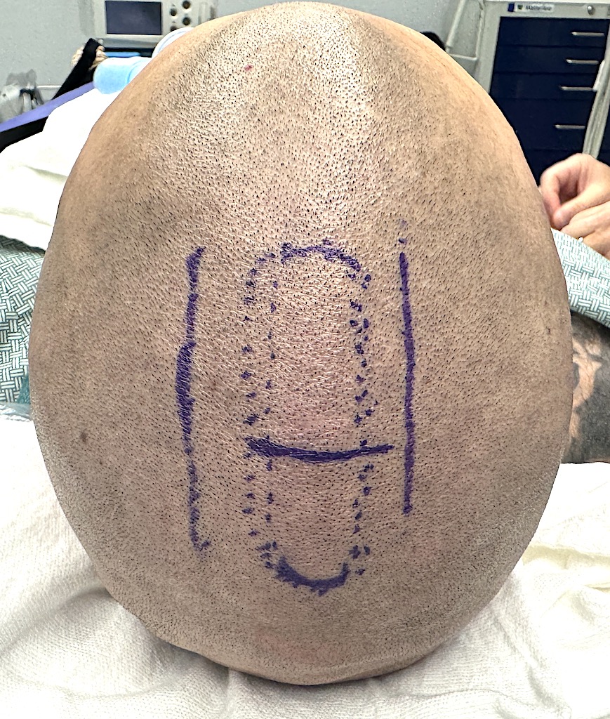 sagittal ridge reduction markings intraop dr barry eppley - Explore ...