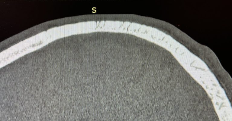 sagittal suture line CT scan Dr Barry Eppley - Explore Plastic Surgery