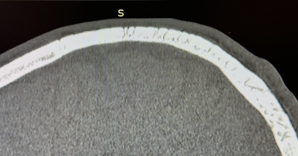 sagittal suture line CT scan Dr Barry Eppley - Explore Plastic Surgery