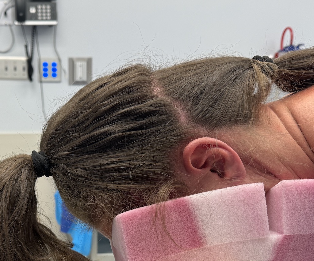 shape of head prior to scalp expander intyraop side view Dr Barry ...