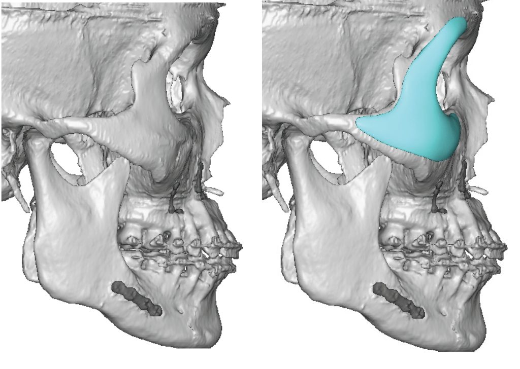 Plastic Surgery Case Study - The Custom Tripod Cheek Implant for Upper ...