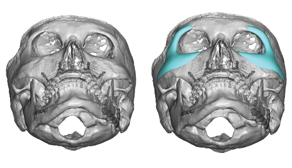 Plastic Surgery Case Study - The Custom Tripod Cheek Implant for Upper ...