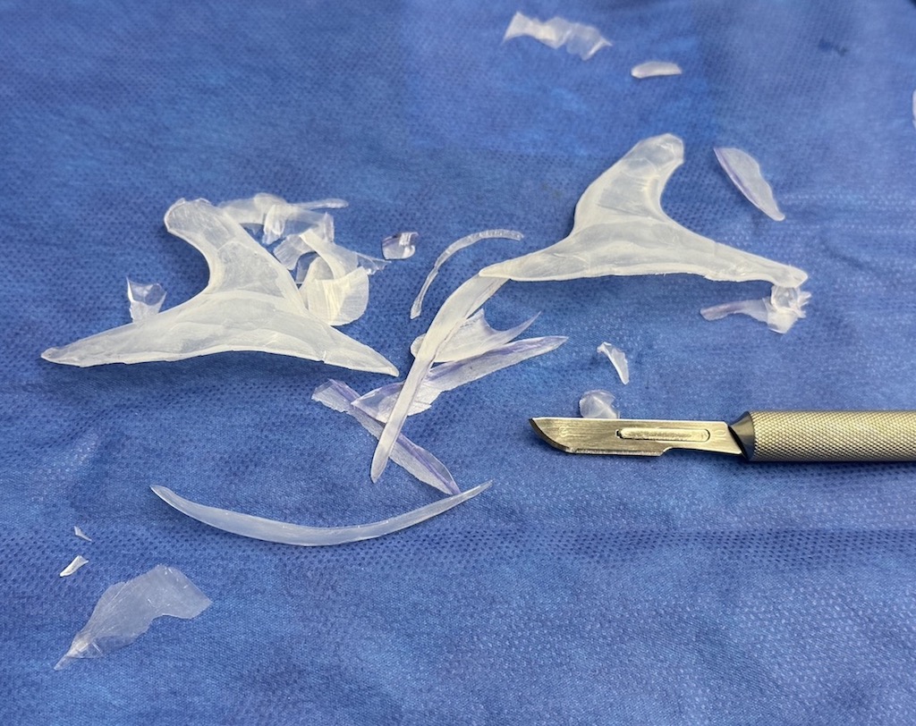 Custom Periorbital Implants intraop modification Dr Barry Eppley ...