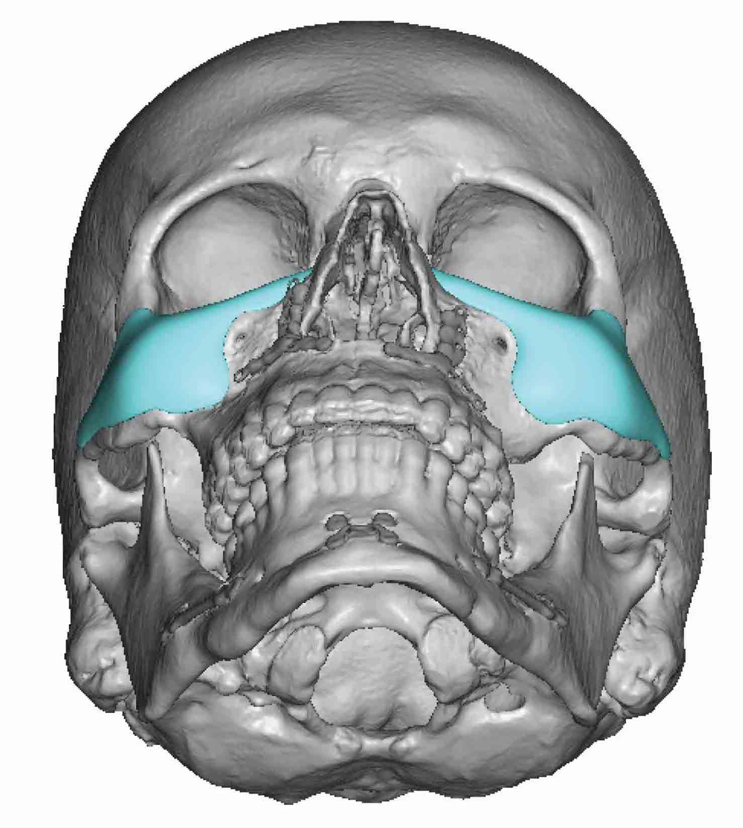 custom IOmMimplant after double jaw surgery design submental view Dr ...