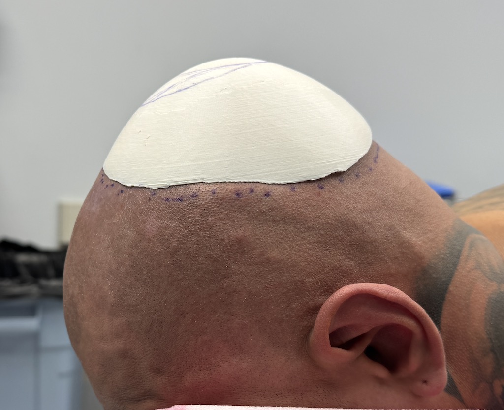 custom back of head implant model on paeint intraop Dr Barry Eppley ...