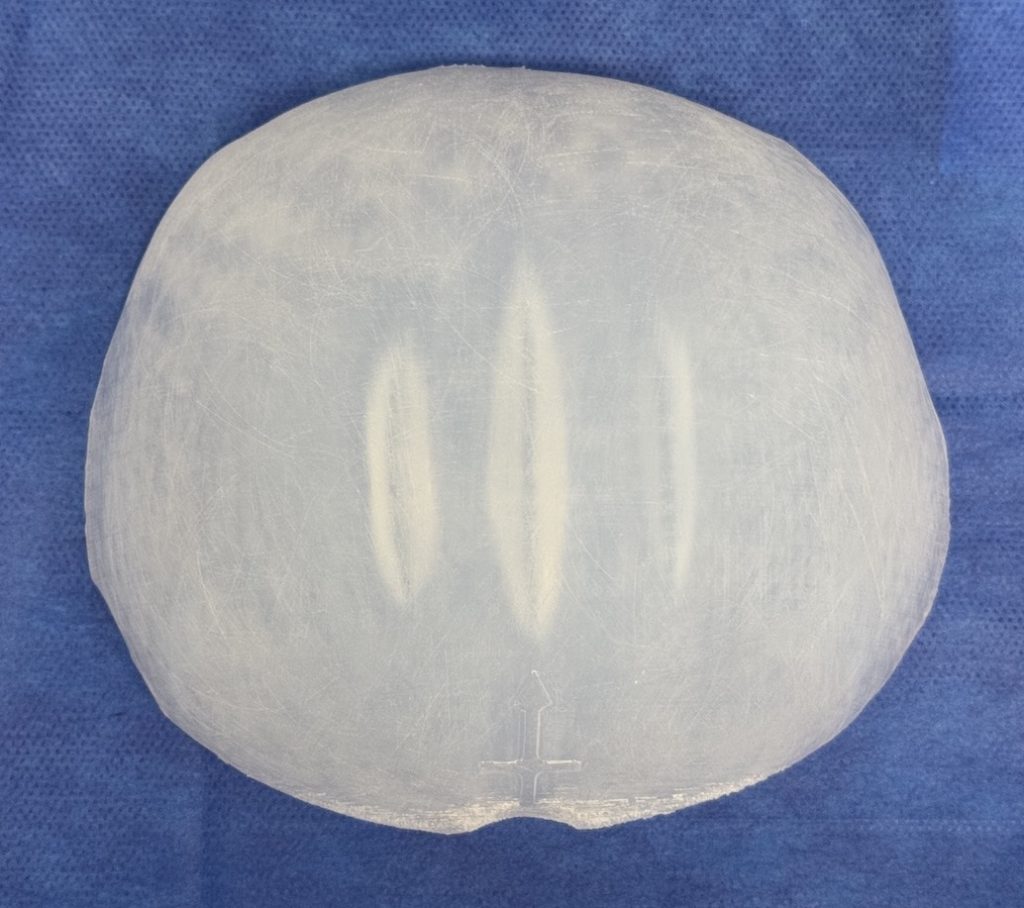 Plastic Surgery Case Study - Custom Forehead and Back of Head Skull ...