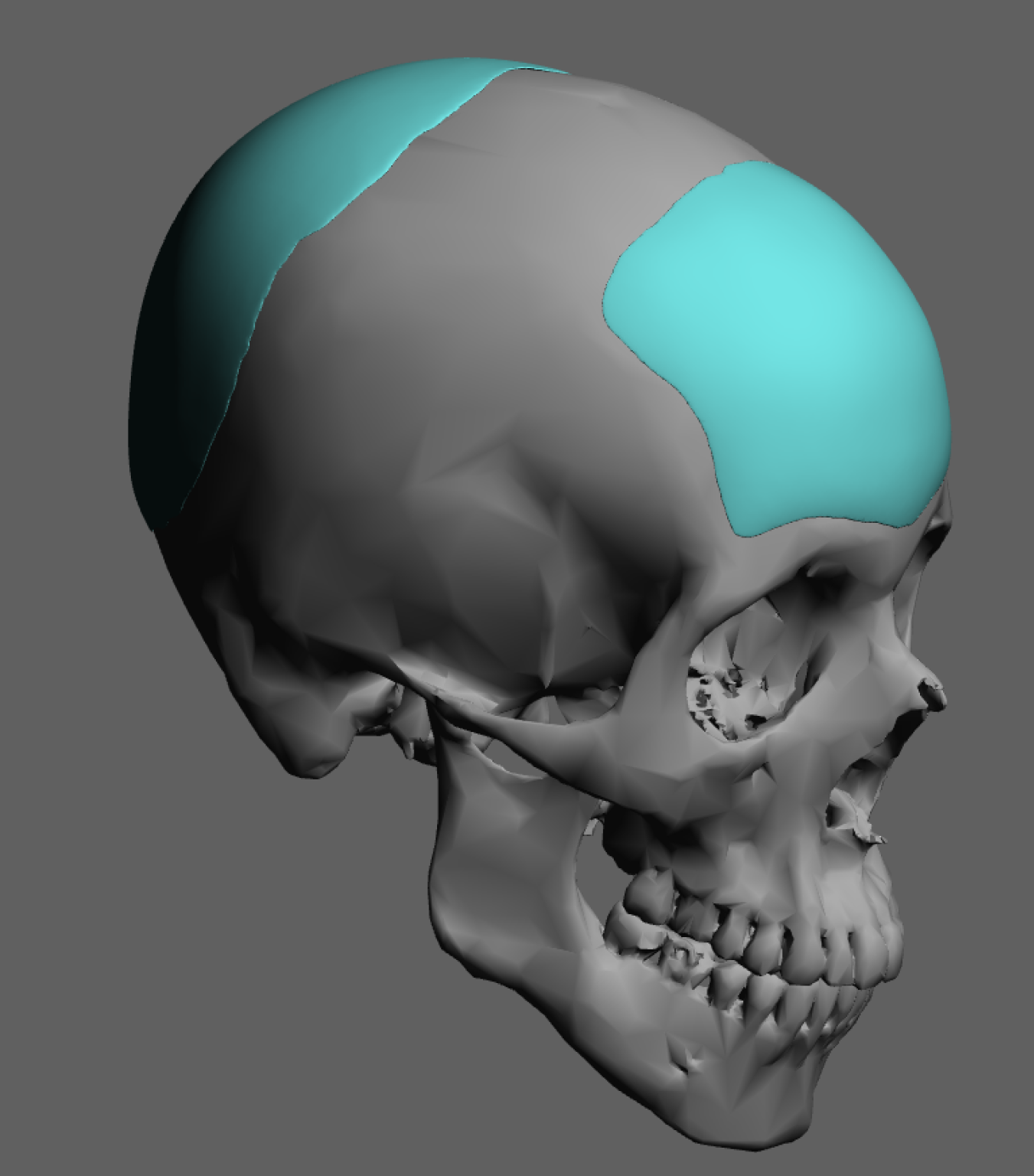 custom forehead and back of head skull implant designs side view Dr ...