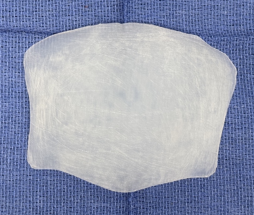 Plastic Surgery Case Study - Custom Forehead and Back of Head Skull ...