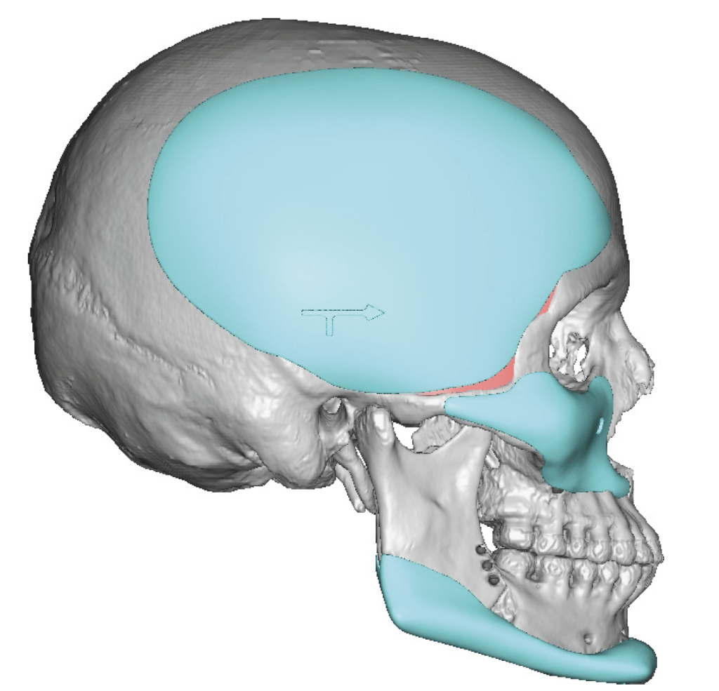 Plastic Surgery Case Study - Custom Jawline Implant for Correction of ...