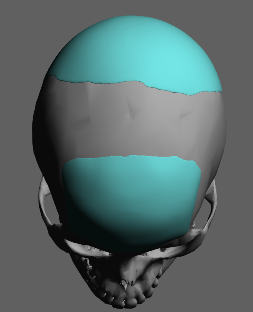 Plastic Surgery Case Study - Custom Back of Head Skull Implant As Part ...