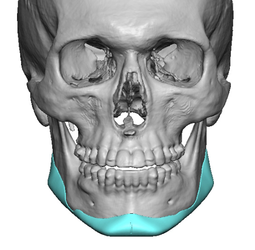 Technical Strategies - Midline Chin Positioning of the Custom Jawline ...