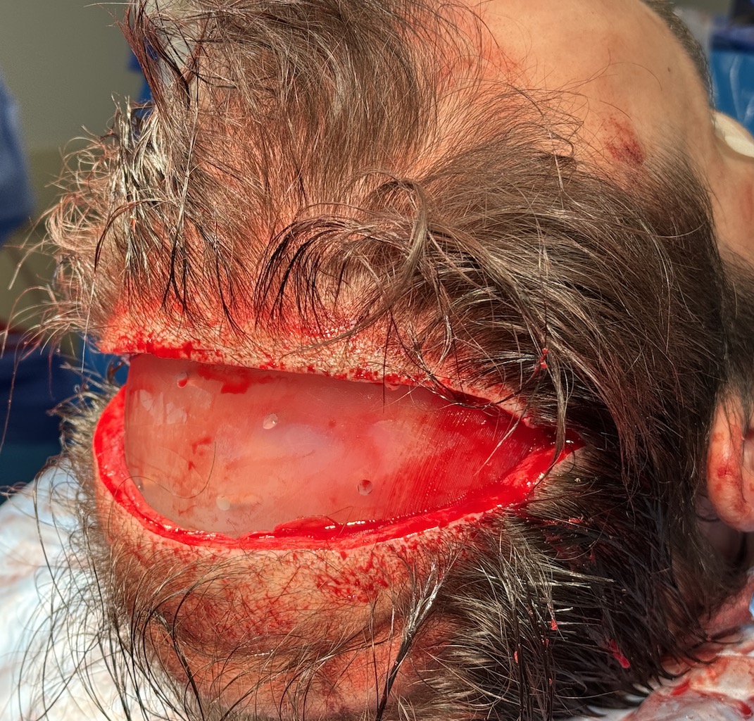 custom skull implant bne cement replacement Dr Barry Eppley - Explore ...