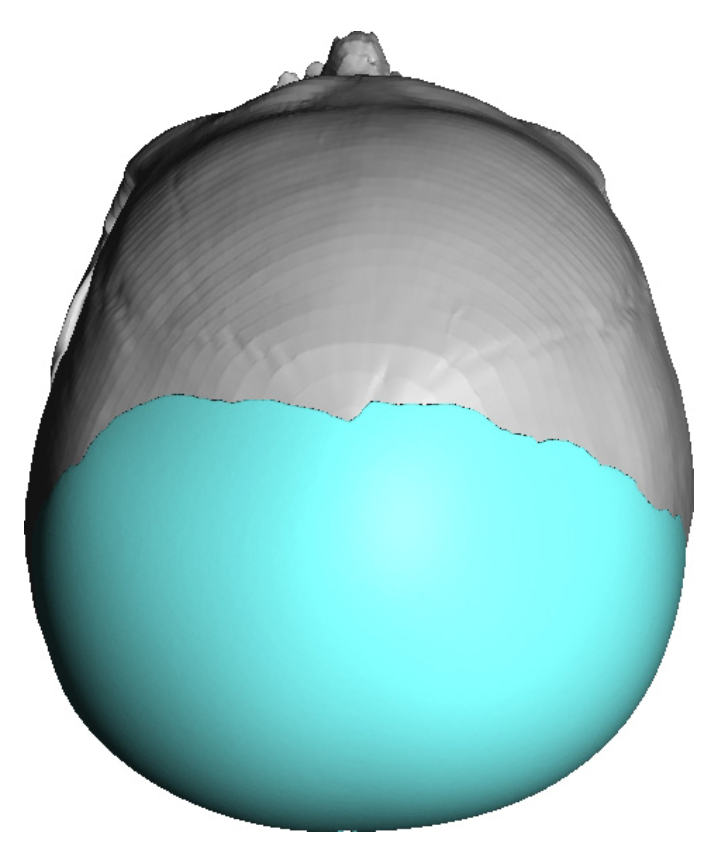 custom skull implant for asymmnetriic back of the head design Dr Barry ...