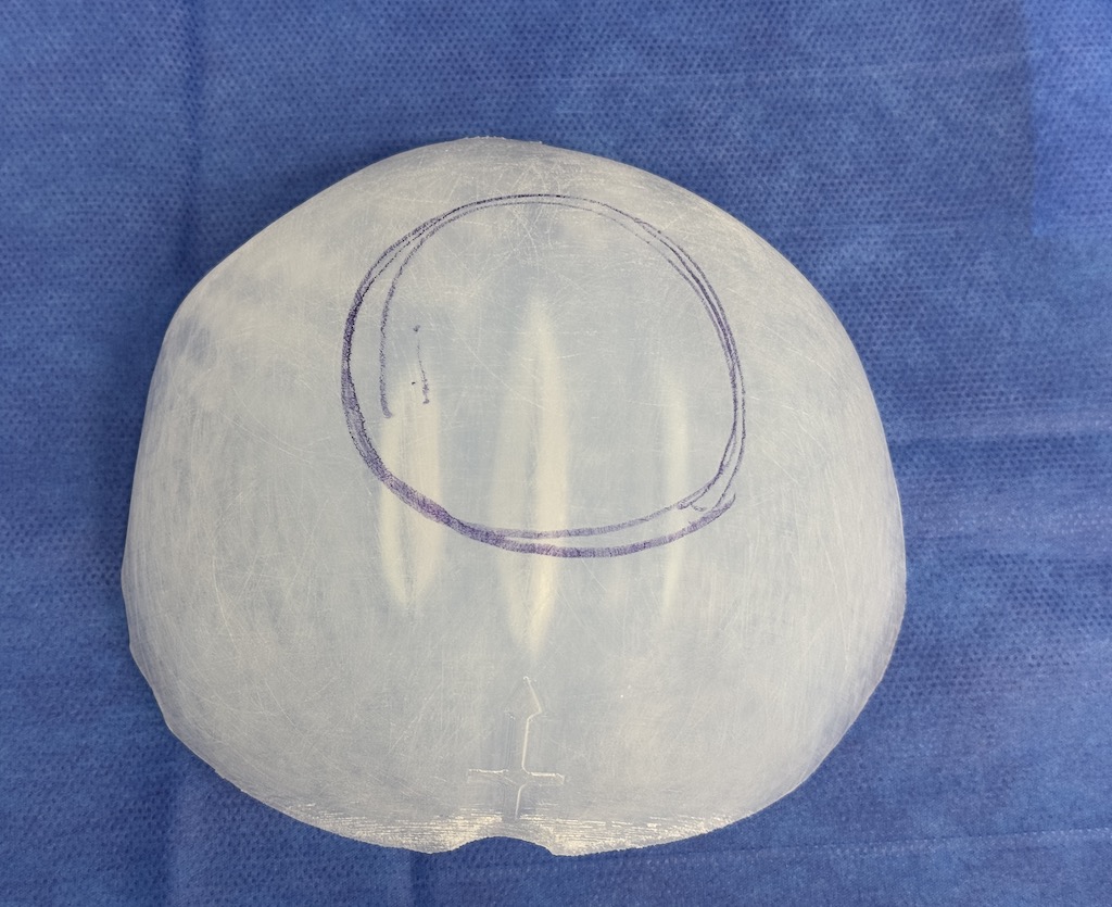 custom skull implant modification area Dr Barry Eppley - Explore ...