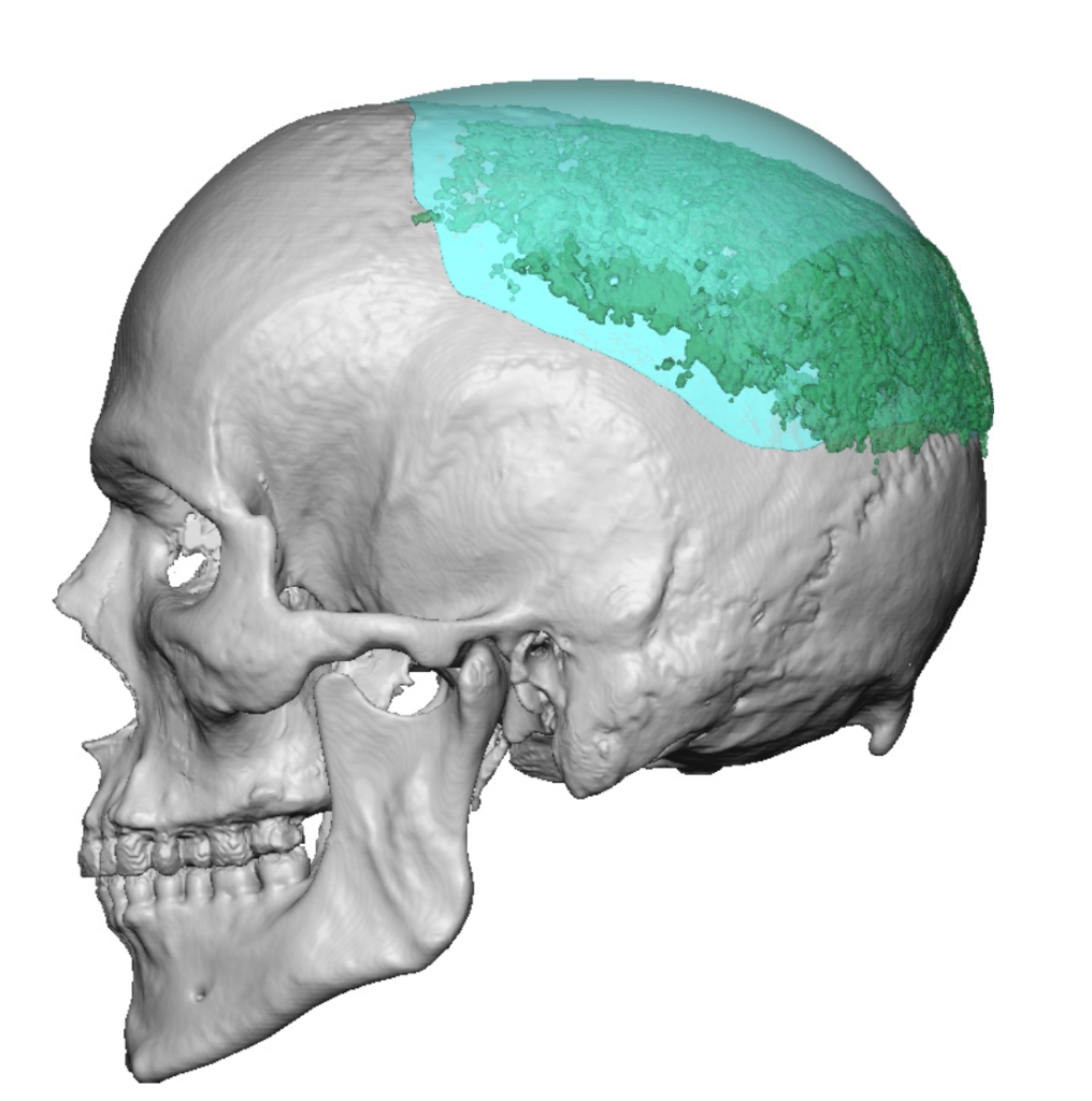 Plastic Surgery Case Study - Custom Skull Implant Replacement for Bone ...