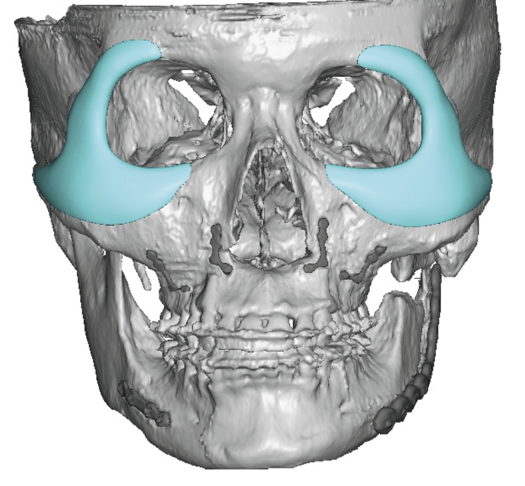 Plastic Surgery Case Study - The Custom Tripod Cheek Implant for Upper ...