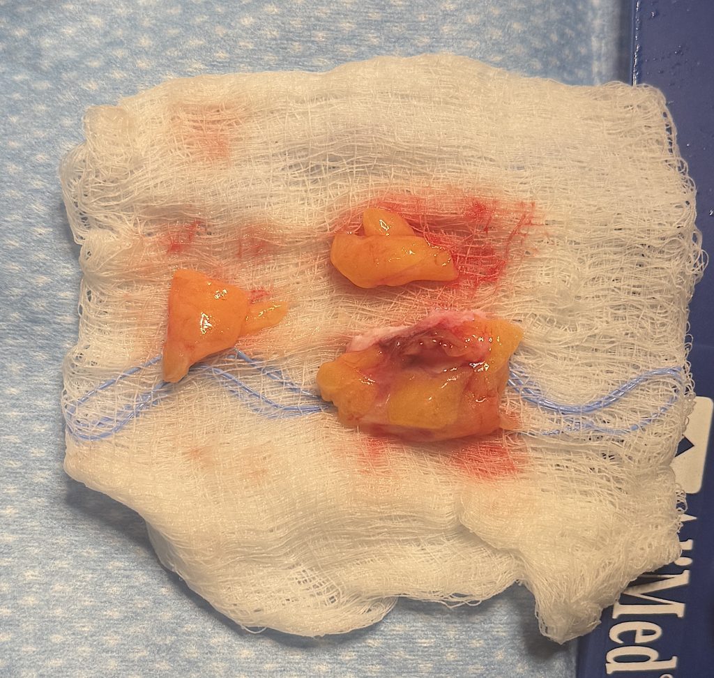 The Use of Release and Dermal-Fat Graft To Treat Lower Lip Tightness ...