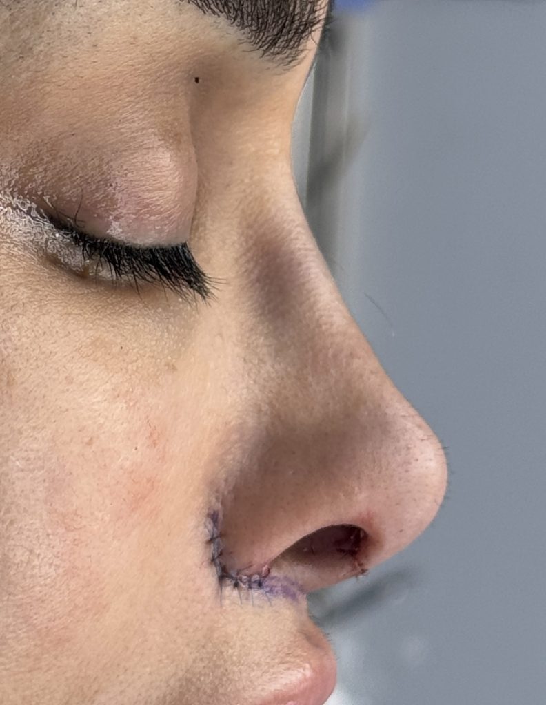 Plastic Surgery Case Study - Secondary Female Rhinoplasty for a Barbie ...