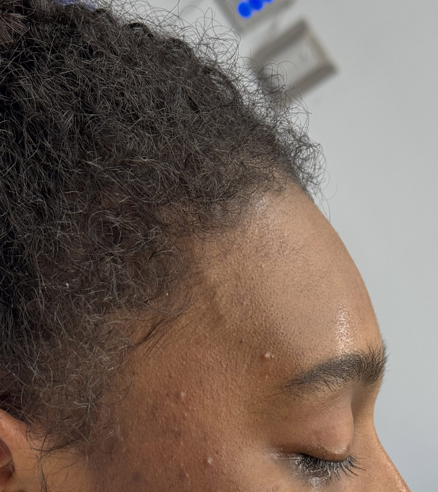 Plastic Surgery Case Study - Extended Custom Forehead Implant for ...