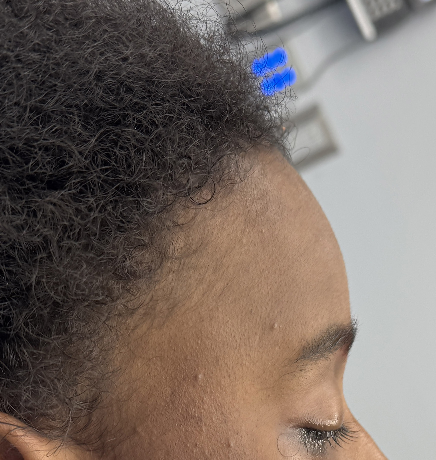 Plastic Surgery Case Study - Extended Custom Forehead Implant for ...