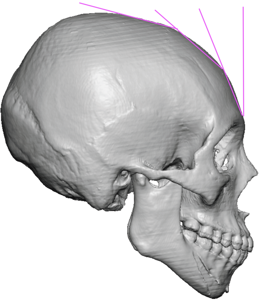 Plastic Surgery Case Study - Extended Custom Forehead Implant for ...