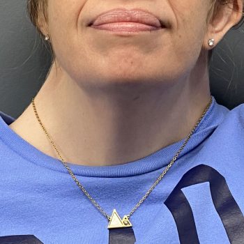 female webbed neck front 1 Dr Barry Eppley - Explore Plastic Surgery